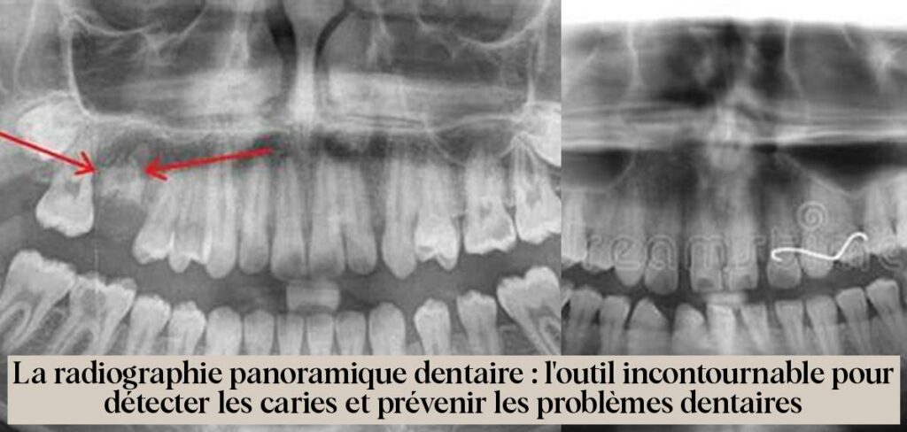 La radiographie panoramique dentaire : l'outil incontournable pour ...